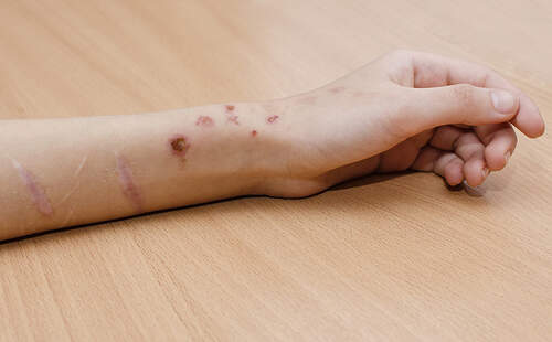 Automutilation: quel soutien social ? - HETSL